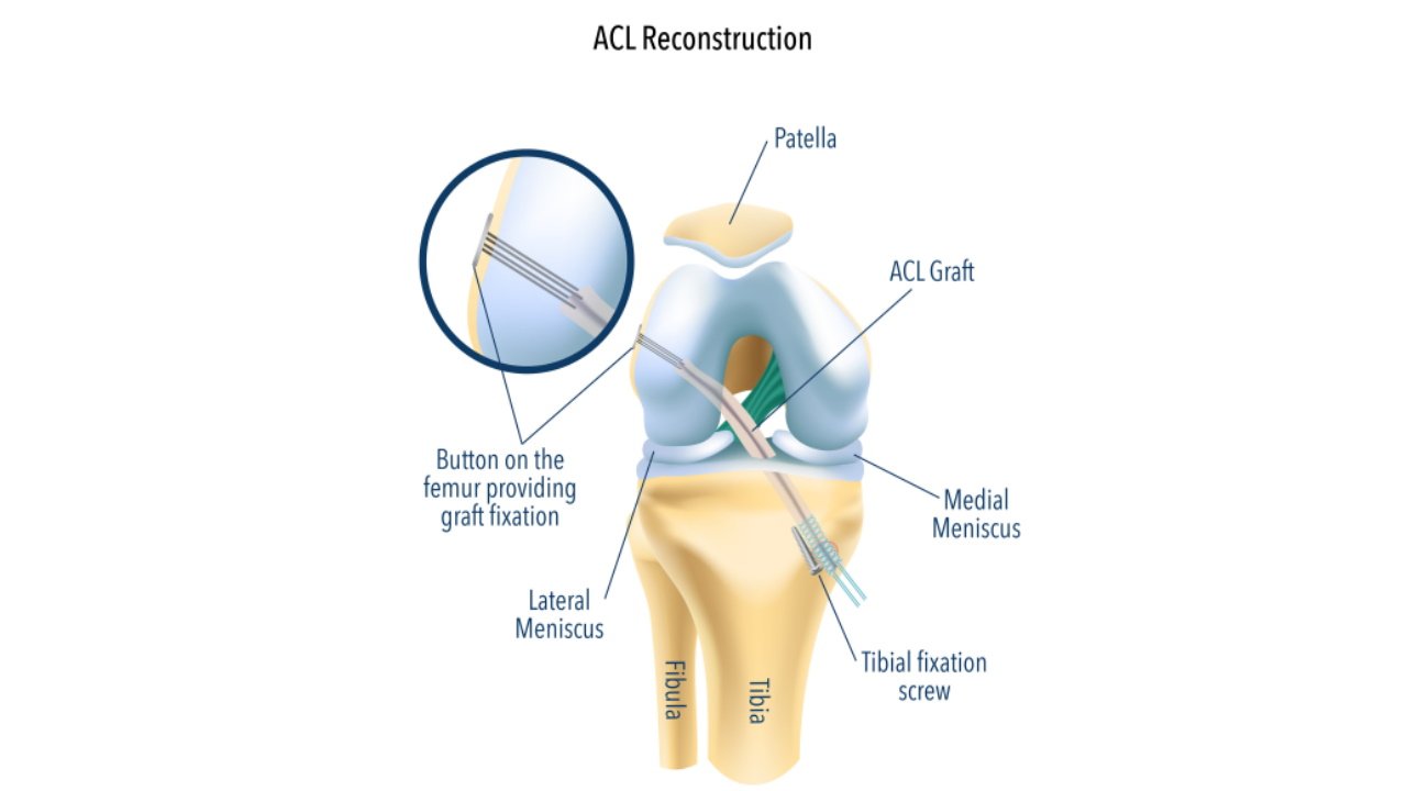 ACL Reconstruction Dr R K Mathur ACL Reconstruction Dr R K Mathur
